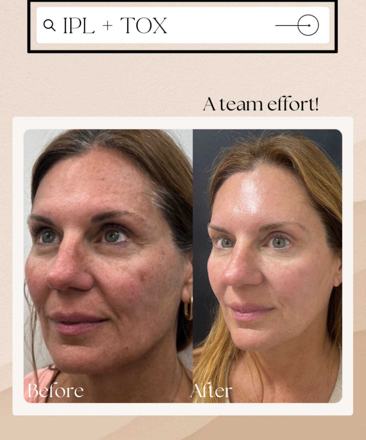 IPL Photo Facials North Scottsdale | The Beauty Fix